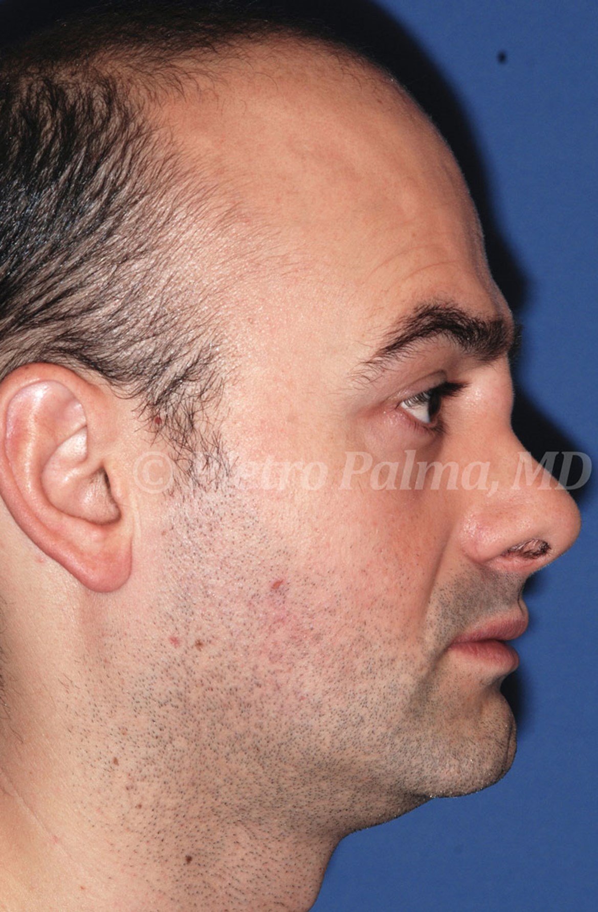 Rediscovering the Lost Art of Endonasal Rhinoplasty | The PMFA Journal