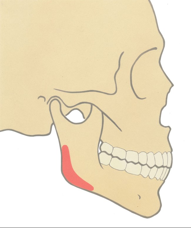 Contemporary aesthetic management strategies for deficient jaw angles ...