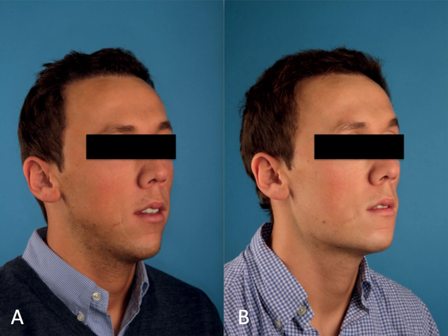 Gonial Angle Jawline Types And Classification Mewing - vrogue.co Gonial Angle Jawline Types And Classification Mewing - vrogue.co