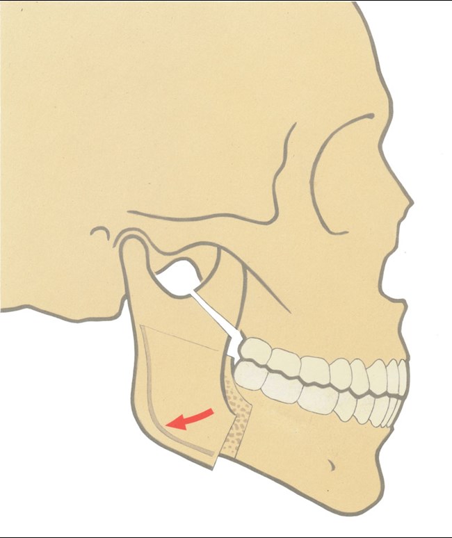 Contemporary aesthetic management strategies for deficient jaw angles ...