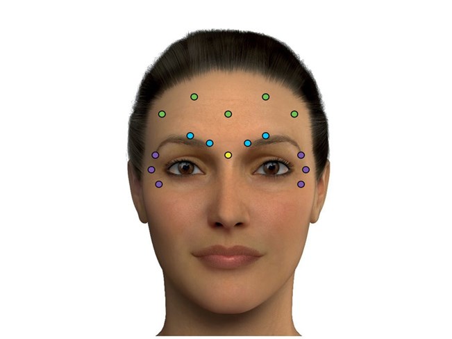 HOW I DO IT Peri-orbital rejuvenation using HA fillers | The PMFA Journal