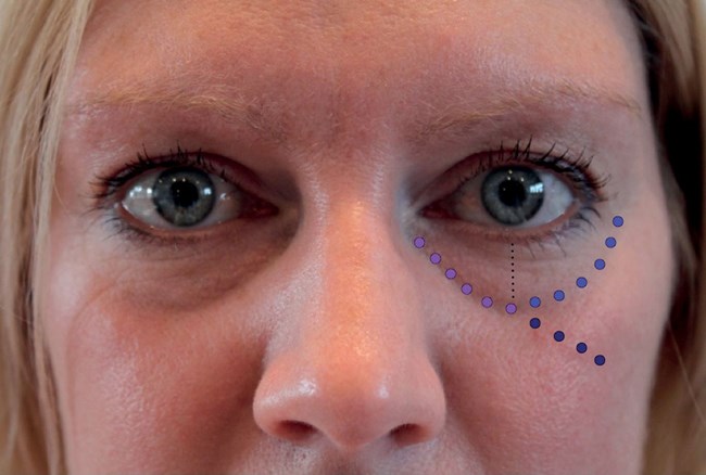 HOW I DO IT Peri-orbital rejuvenation using HA fillers | The PMFA Journal