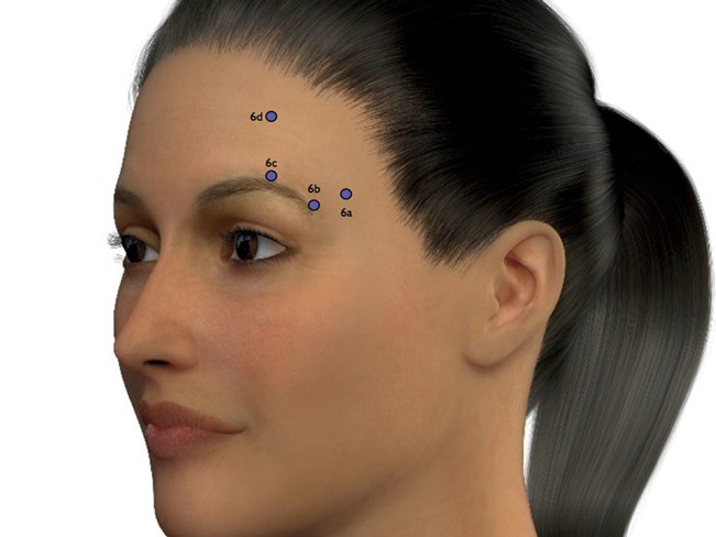 HOW I DO IT Peri-orbital rejuvenation using HA fillers | The PMFA Journal