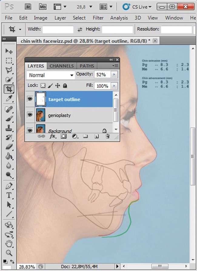 Photoshopping the face: simulated outcomes of orthofacial surgery | The ...