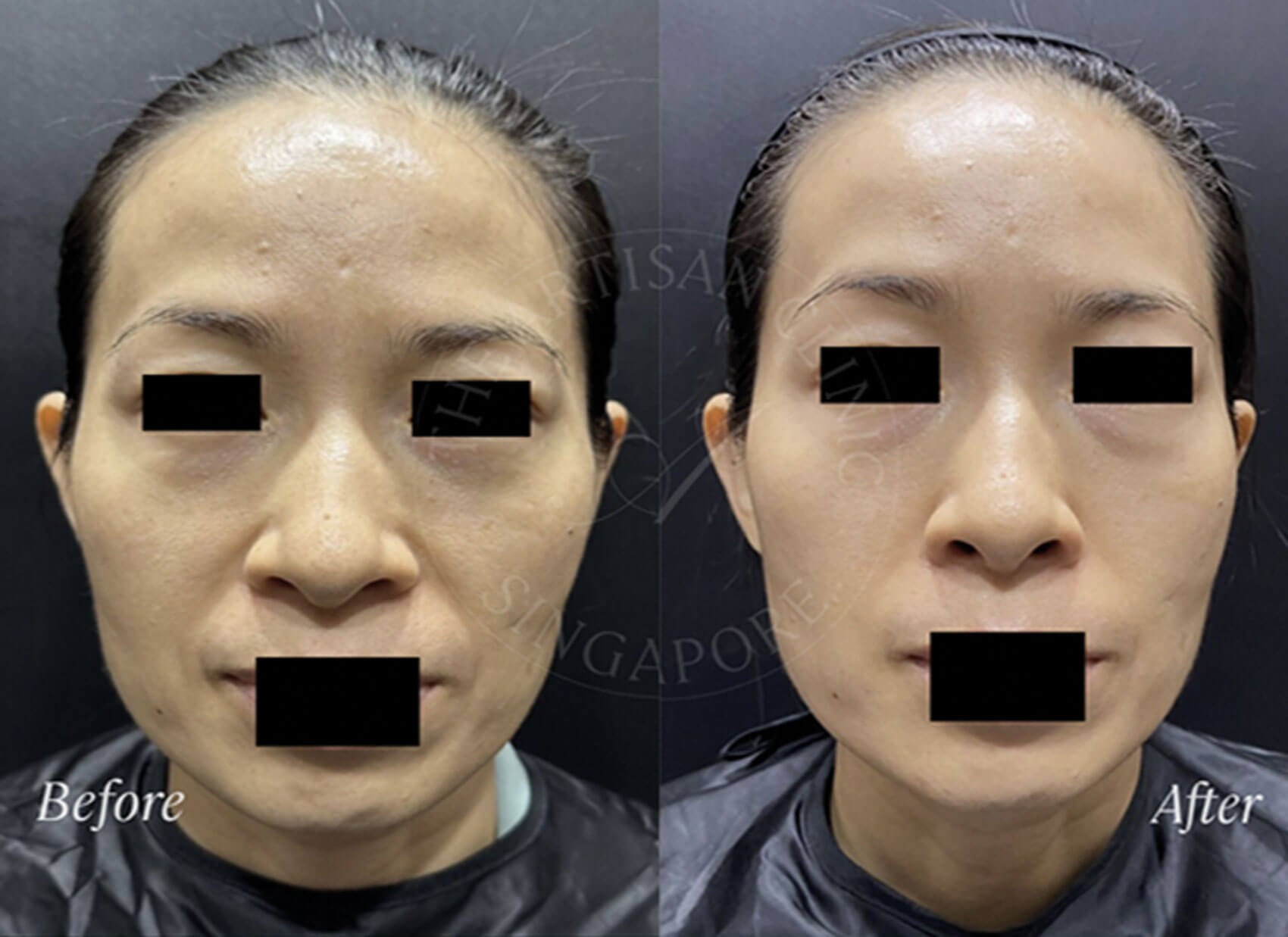 Liquid Polycaprolactone Collagen Stimulator For Natural Facial Anti