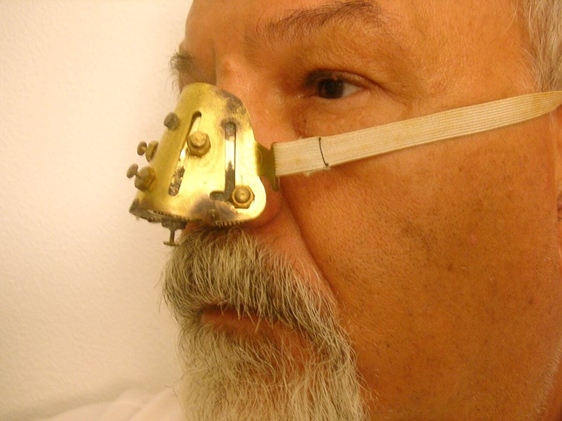 The golden nose – reshaping the nose 100 years ago | The PMFA Journal