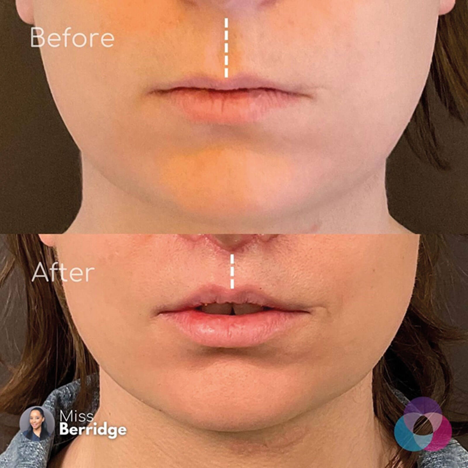 How I Do It Surgical Upper Lip Lift The Pmfa Journal
