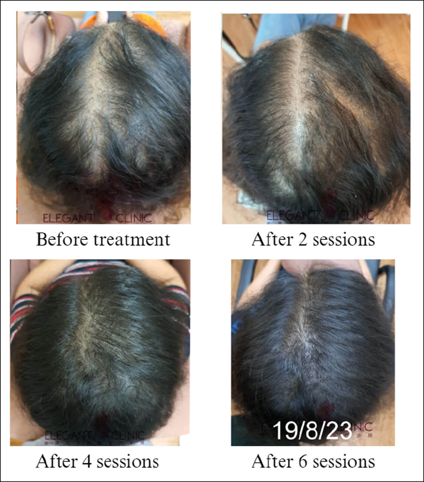 Chronic telogen effluvium reversal using E. coli derived cytokines and growth factors a case report The PMFA Journal