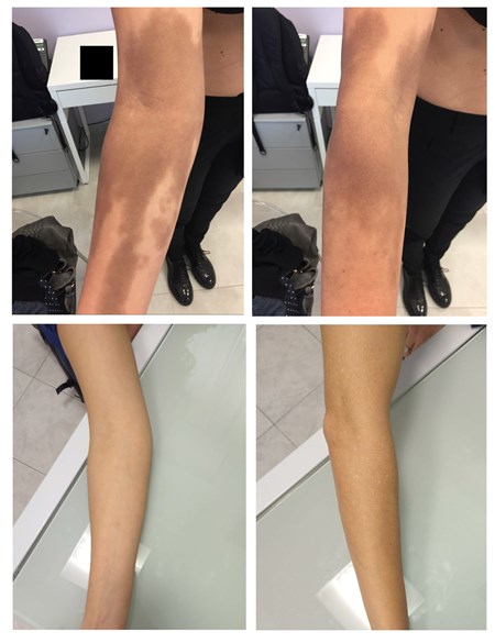 Post-infusion iron extravasation: Cutaneous complications and ...