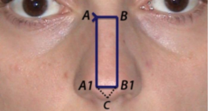 Closed rhinoplasty Serdev techniques | The PMFA Journal