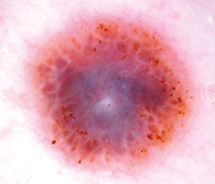 Dermoscopy: an update and personal view | The PMFA Journal