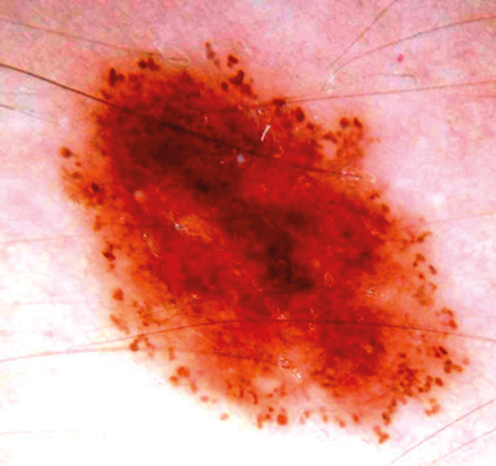 Dermoscopy: an update and personal view | The PMFA Journal