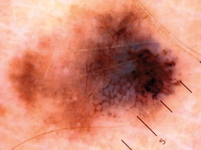 Dermoscopy: an update and personal view | The PMFA Journal