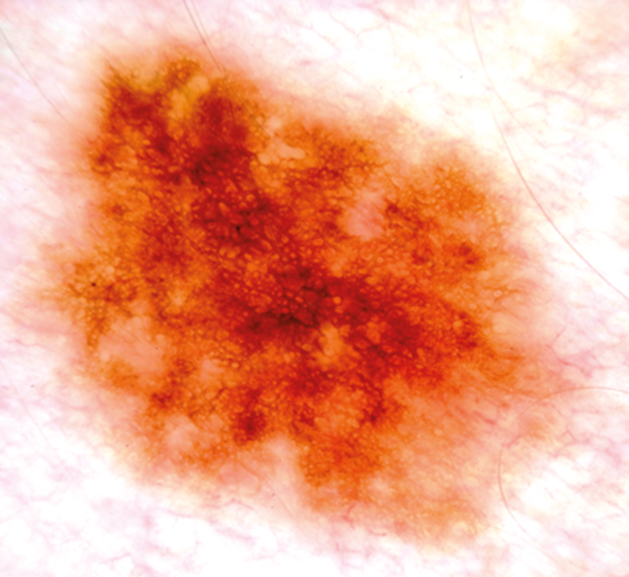 Dermoscopy: an update and personal view | The PMFA Journal