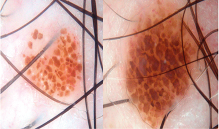 Dermoscopy: an update and personal view | The PMFA Journal